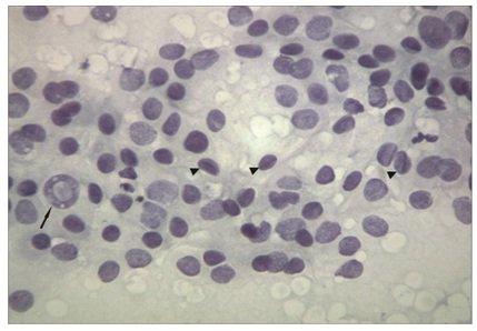 show anisonucleosis, nucleomegaly (arrow) and fine powdery chromatin ...