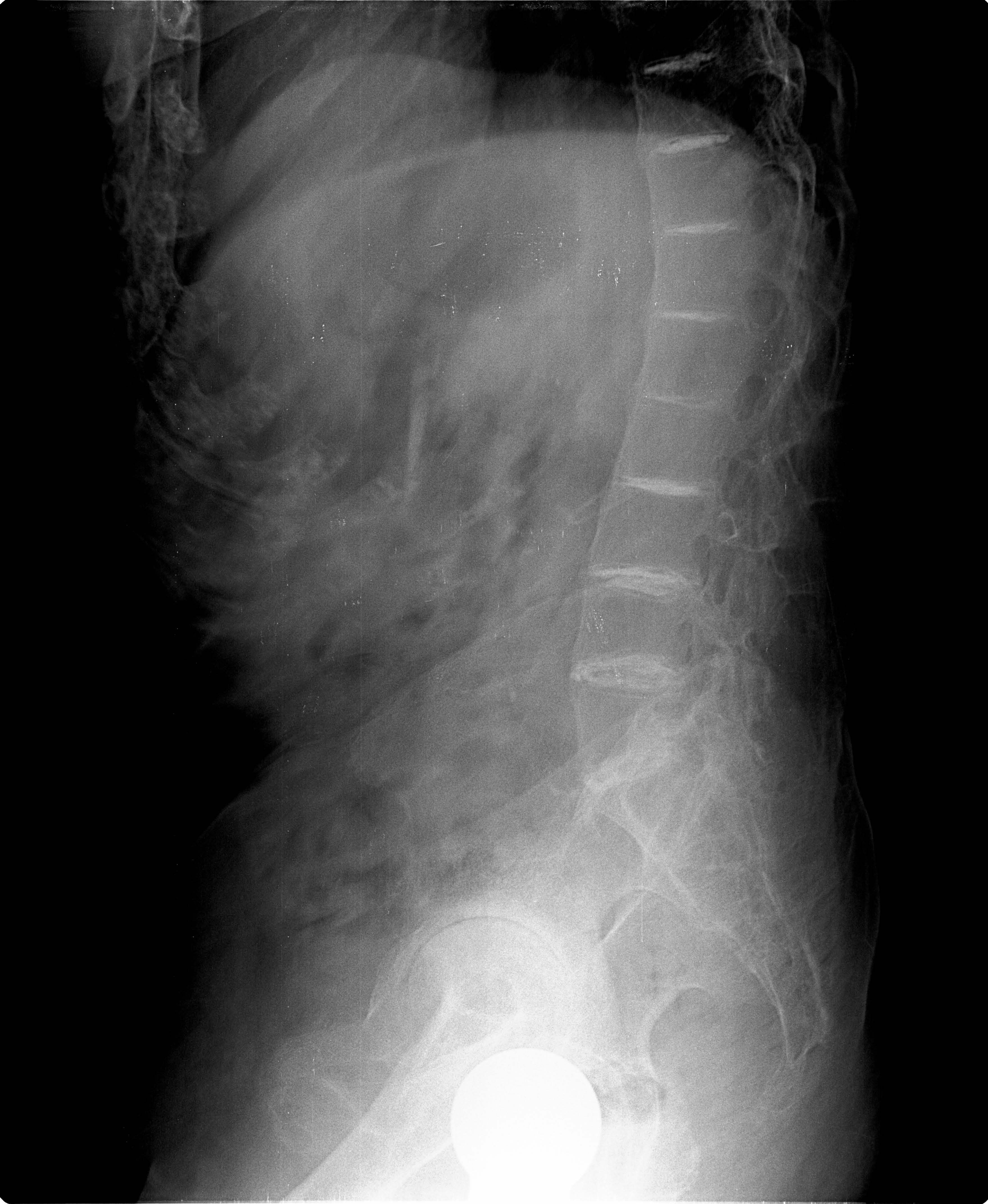 Ochronosis Xray