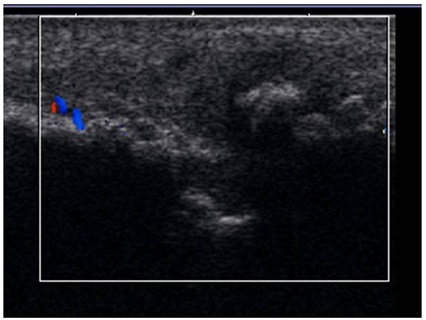 USG at fracture site showing vascularization in callus