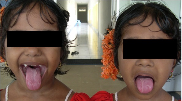 Can Geographic Tongue Affect Lips And Eyelashes | Lipstutorial.org