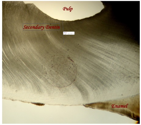 Ground section of the tooth showing the thickness of secondary dentin ...