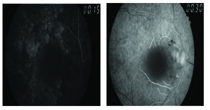MRI Scan showing old multiple lacunar infarcts