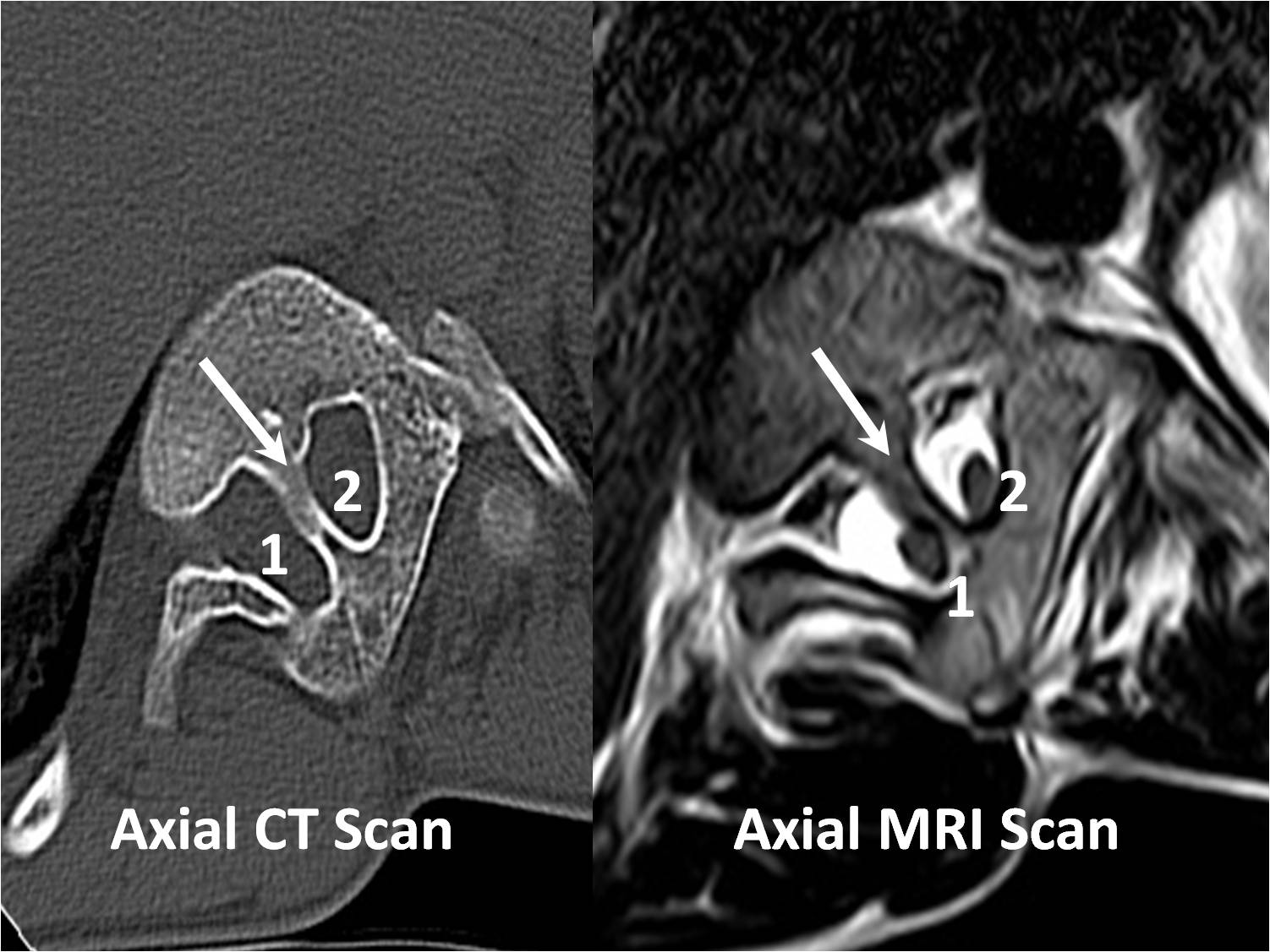 Axial CT and Axial MRI showing calcified bar splitting the spinal cord ...