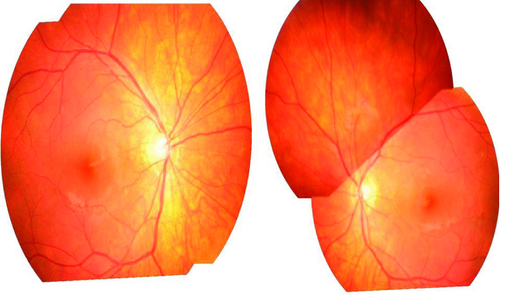 The patient was found to be asymptomatic at the end of a three year ...