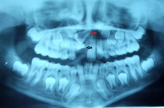Dilaceration Teeth