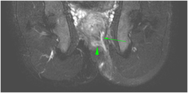 Perianal Fistula Mri Types