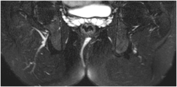 Is coronal T2WFS image showing transsphincteric primary tract. It was a ...