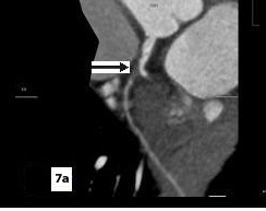 Catheter angiography image showing significant stenosis of OM1 at ...