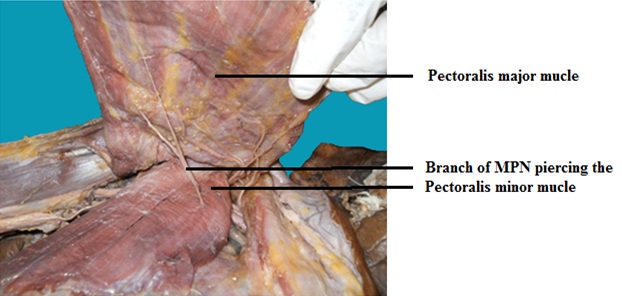 Pectoralis Minor Cadaver