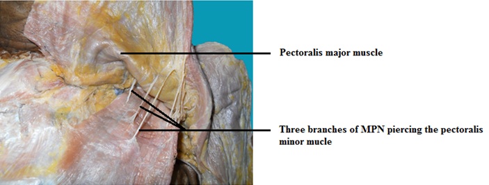 Pectoralis Minor Cadaver