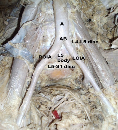 Lumbar Arteries Cadaver