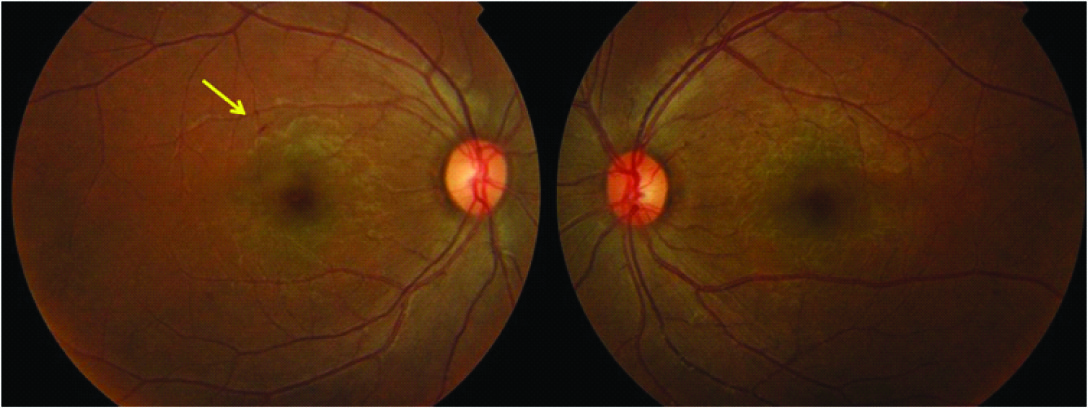 Ophthalmic Artery Rupture Bleeding Eye