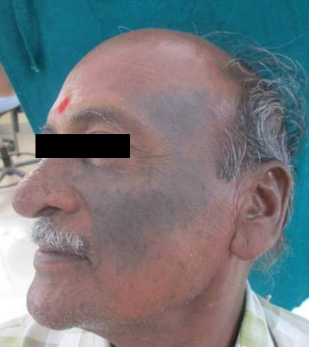 Amiodarone Blue Skin Discoloration