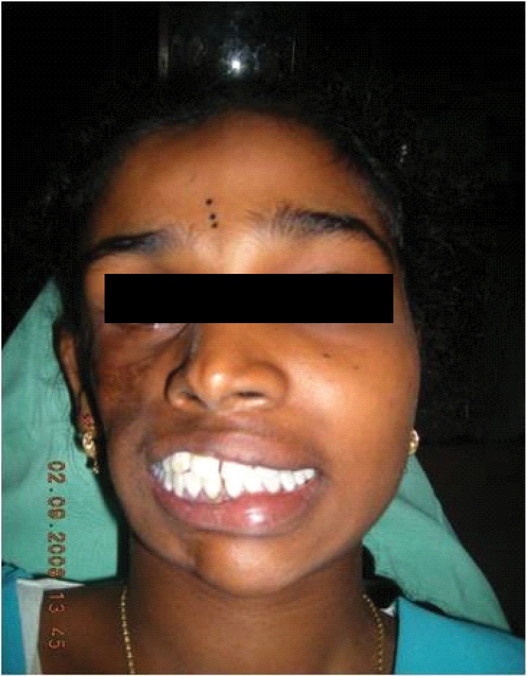 Severe Parry Romberg Syndrome