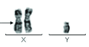 Karyotype showing 47,XYY