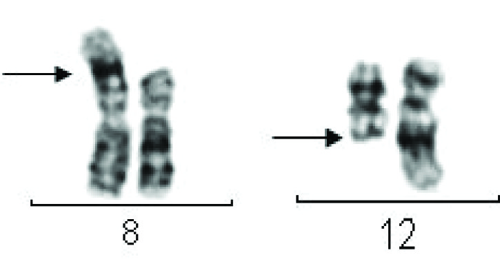 Karyotype showing Robertsonian translocation between chromosomes 13 and ...