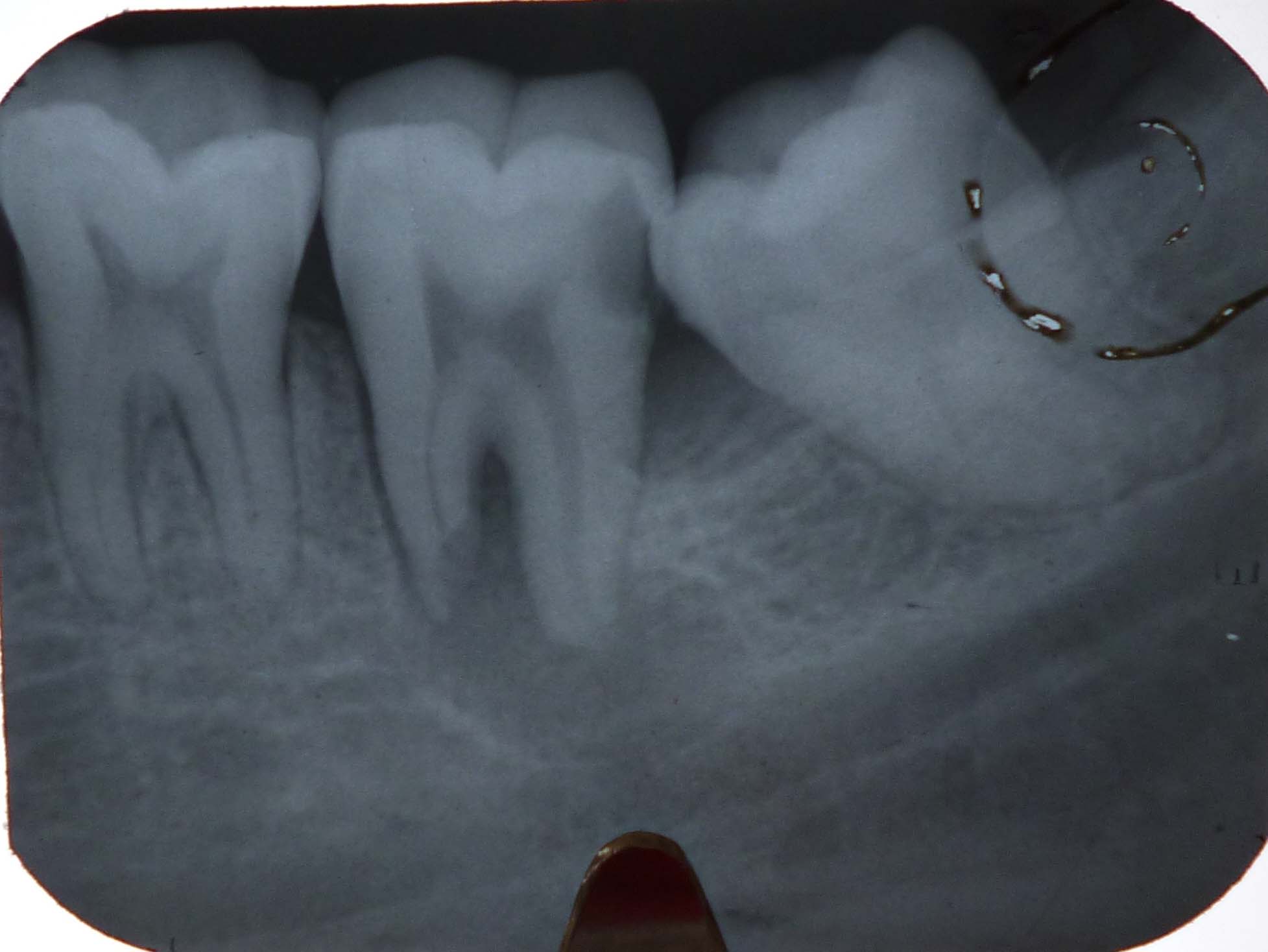 A mesioangular impaction of mandibular third molar with a developing ...