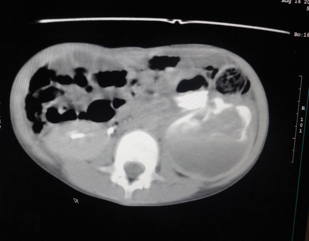 CT scan abdomen showing left hydronephrotic kidney with left ...