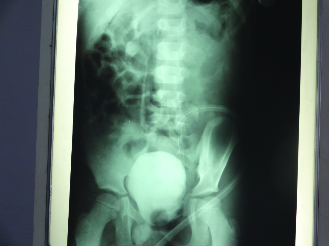 Kidney X Ray With Dye