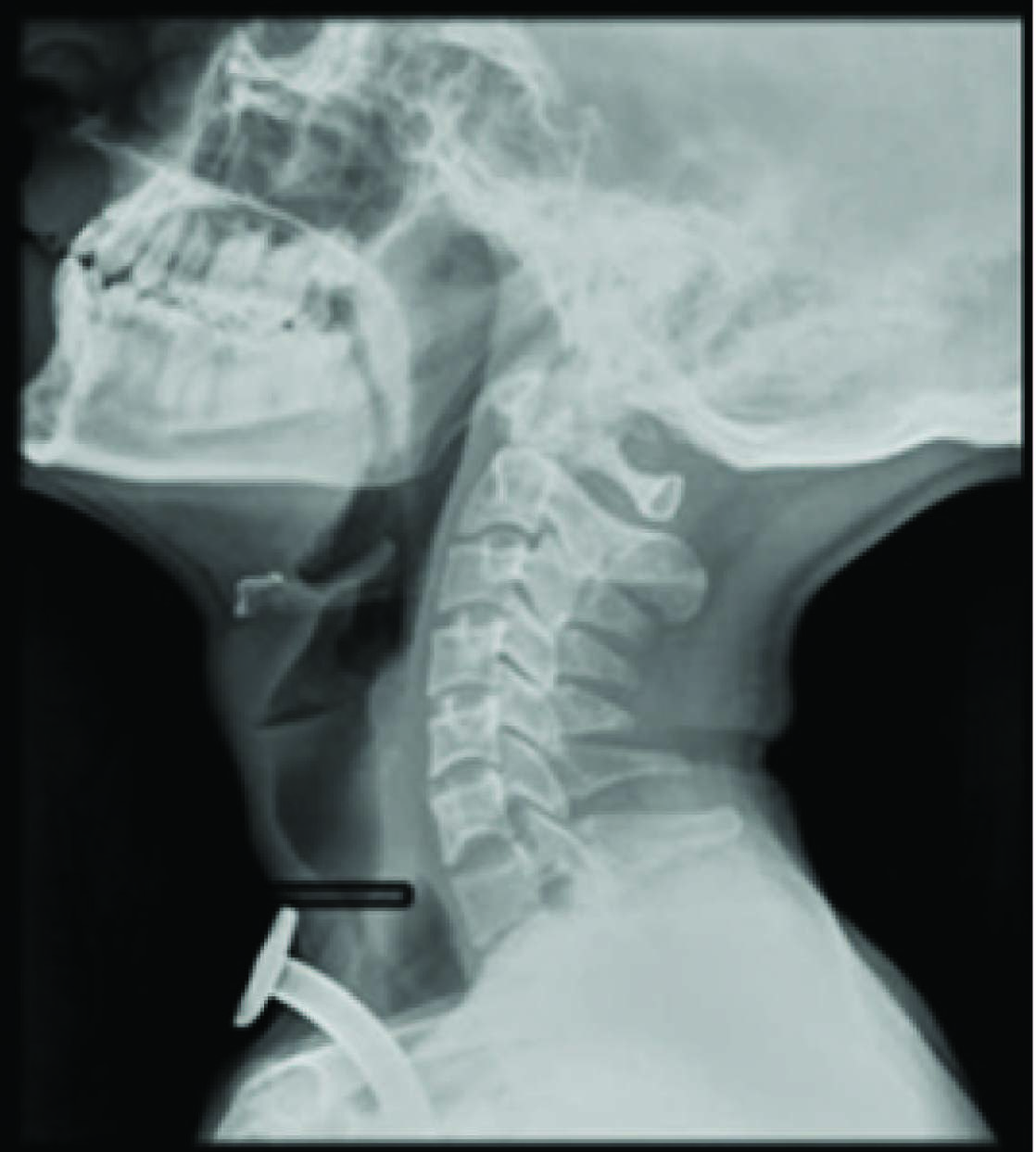 Level of sub glottis stenosis