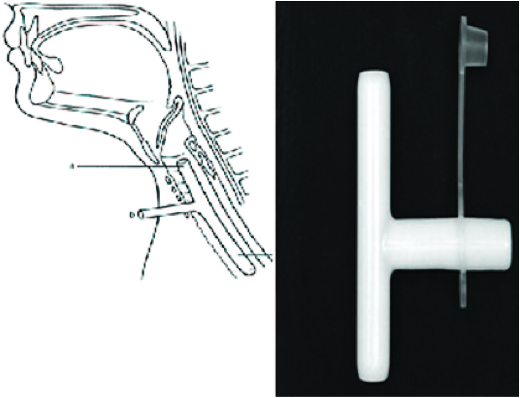 What Comes With The Montgomery T Tube