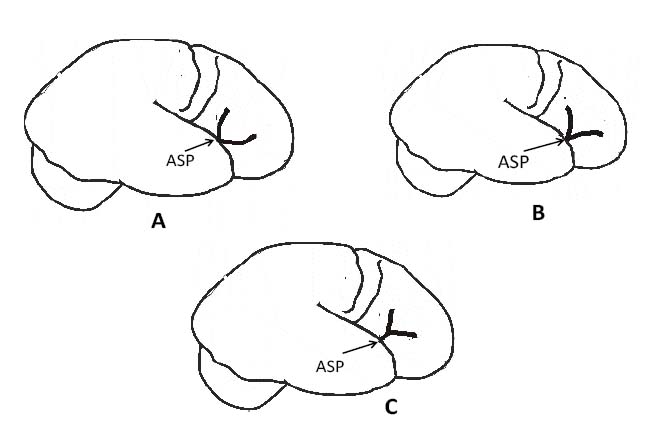 The various configuration of the anterior ascending and anterior ...