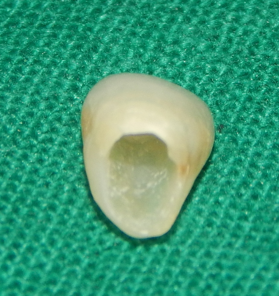 Image showing prepared biologic crown