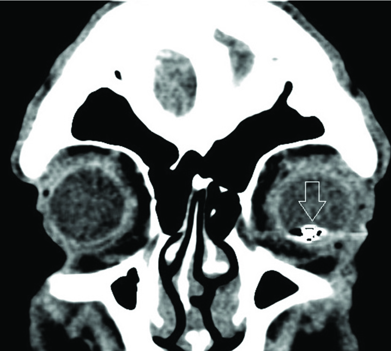Coronal CT orbit shows foreign body producing streak artifacts in the ...