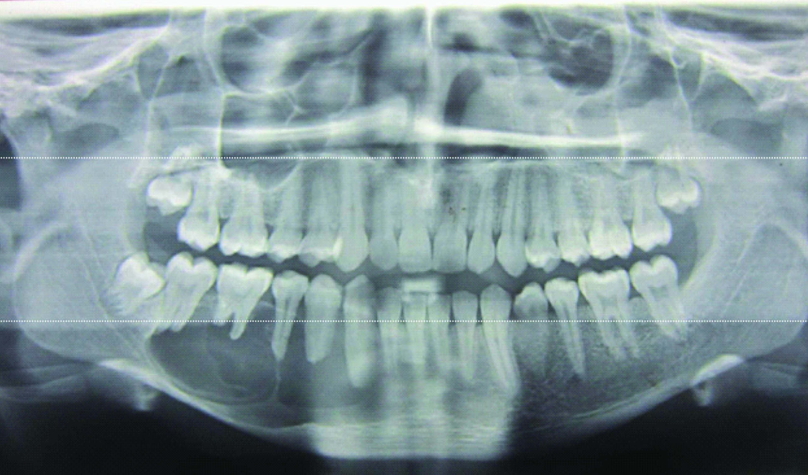 Botryoid Odontogenic Cyst