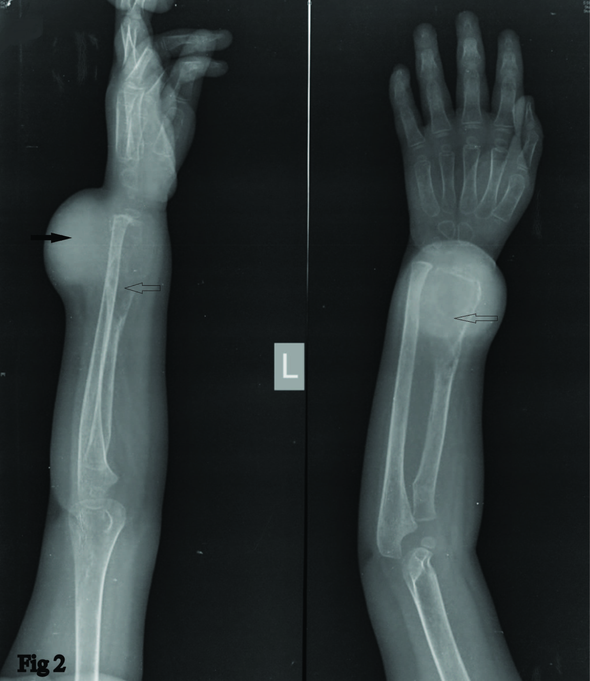 Radiograph showing bony lesion distal radius (arrow) with soft tissue ...