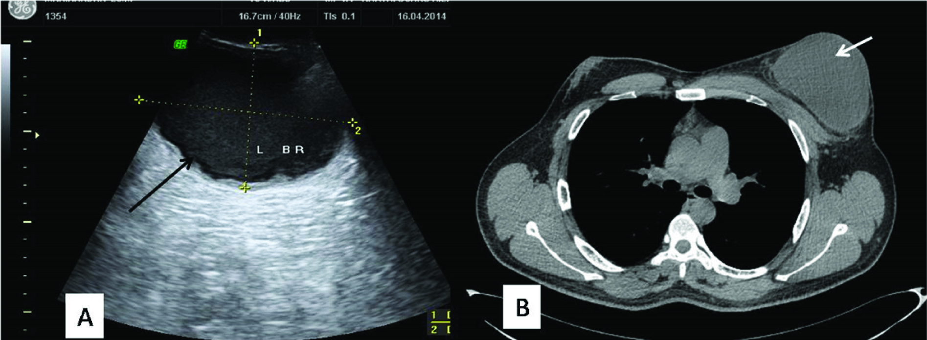 (A) Ultrasound image showing well defined thick walled collection in ...