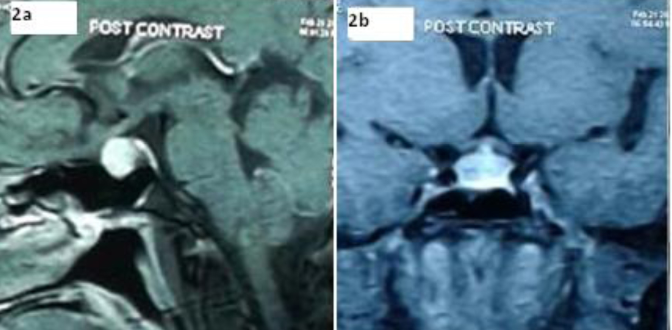Panhypopituitarism Mri
