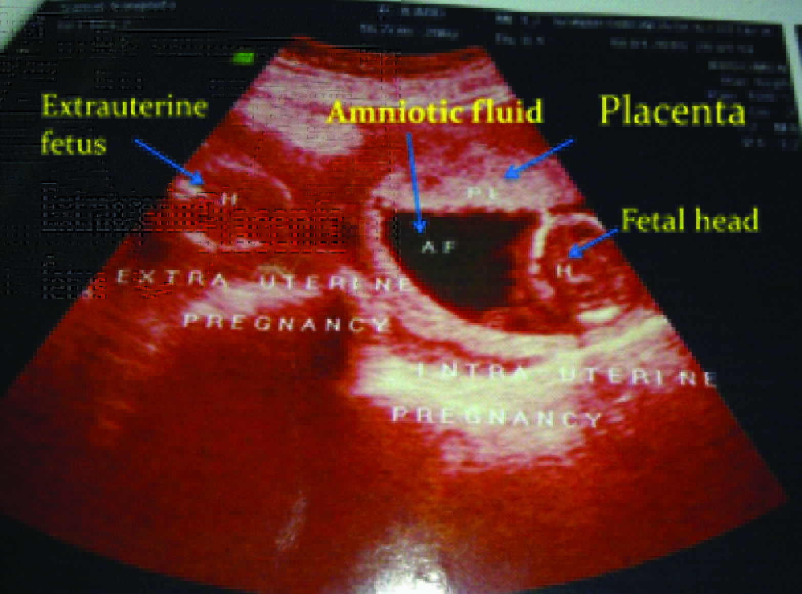 Uterine Cavity Ultrasound The Diagnosis and Treatment for a Special ...