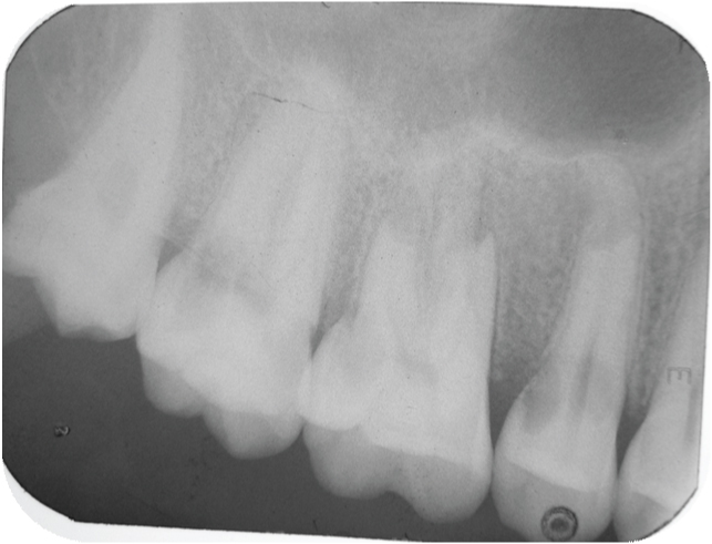 Intraoral periapical radiograph showing cervical resorbtion in relation ...