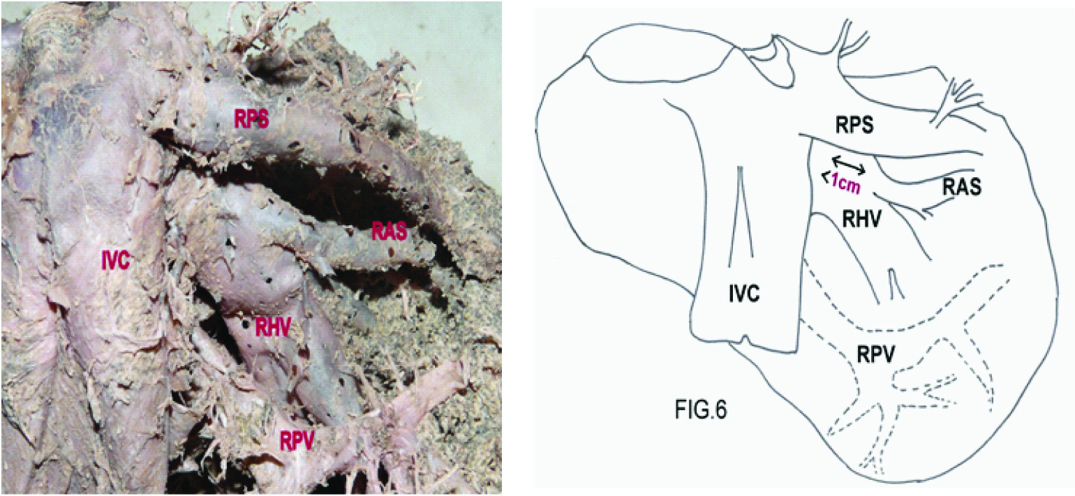 Type I shows RHV larger in calibre than IRHV. RHV= right hepatic vein ...