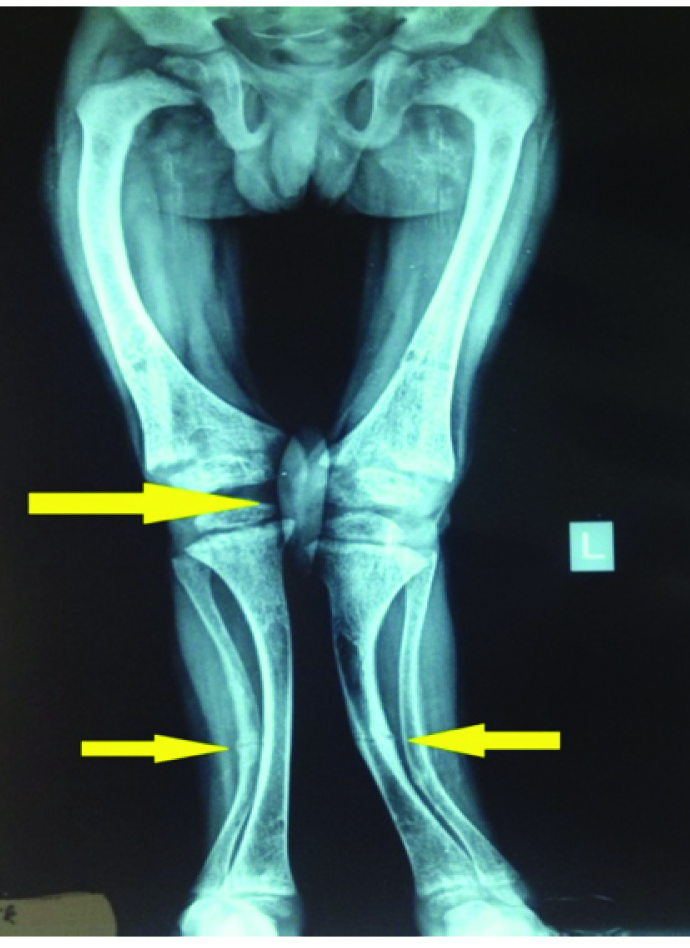 X-ray of lower limbs showing features of rickets;