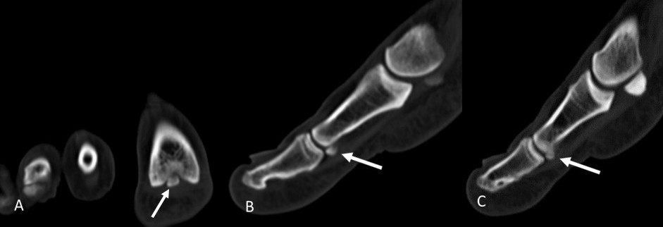 CT scan coronal (A) and sagittal (B,C) images accurately localises the ...