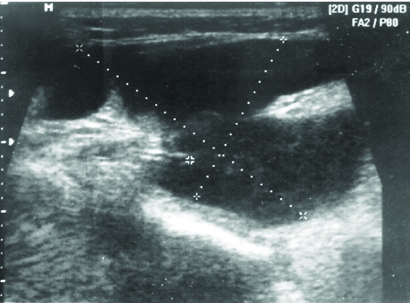 Ranula Ultrasound