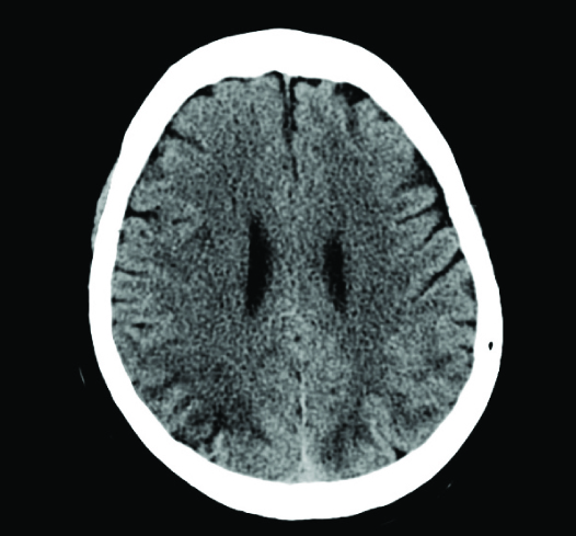 MRI showing white matter hypodensities in parieto-occipital regions