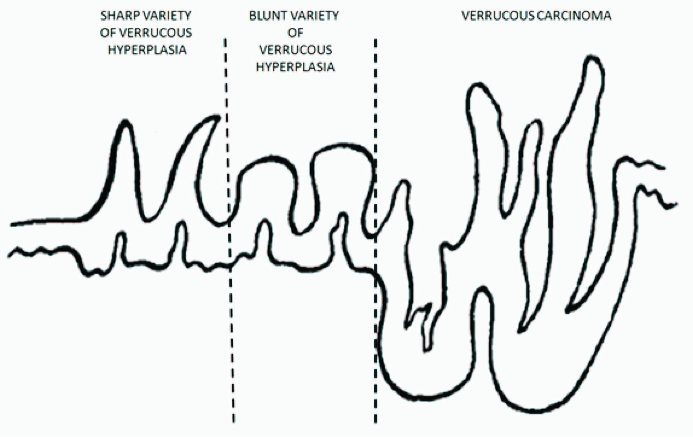 Proliferative Verrucous Leukoplakia Histology