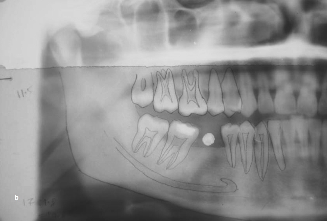 Showing IOPA Immediately, after 1 st and 3 rd month post operatively ...