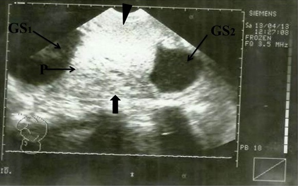 Circummarginate Placenta Ultrasound