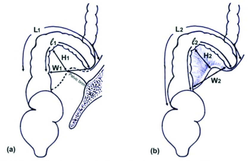 Sigmoid Mesocolon