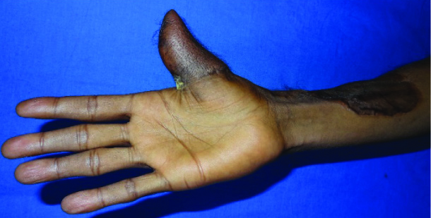 Radial Forearm Distally Based Osteocutaneous Flap - Delayed plate ...