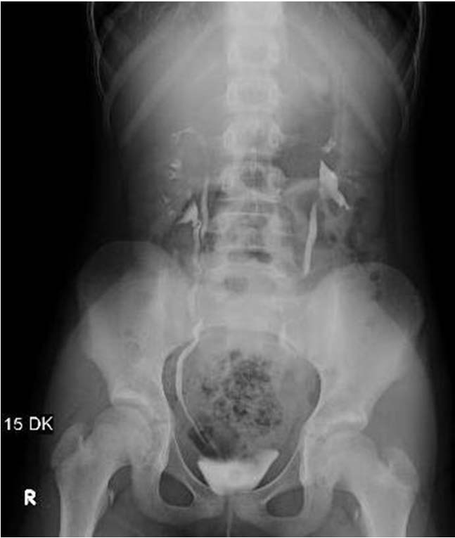 Double collecting system on the right