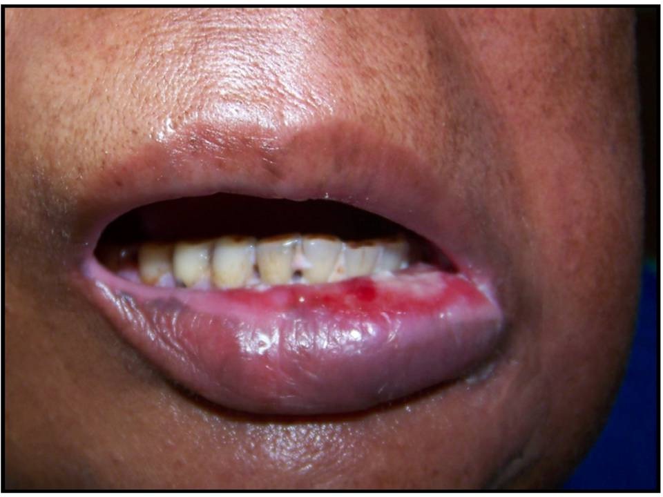 Patient with Grade III mucositis: ulcers/requires liquid diet only