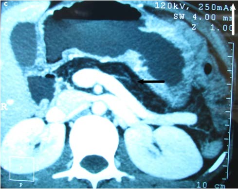Contrast CT shows complete pancreatic atrophy