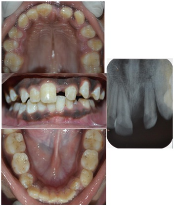 Intra oral photographs and IOPA