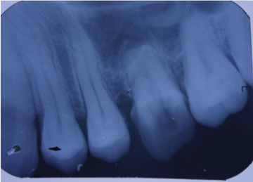 IOPA showing deep caries, peri-apical pathology and bone loss in ...