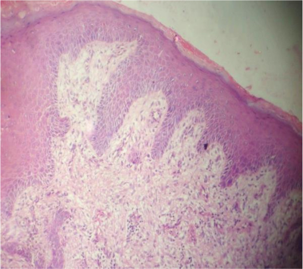 Epulis Histology
